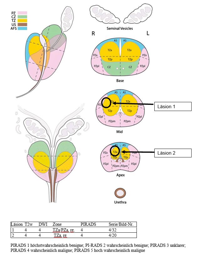 Multiparametrisches MRT der Prostata